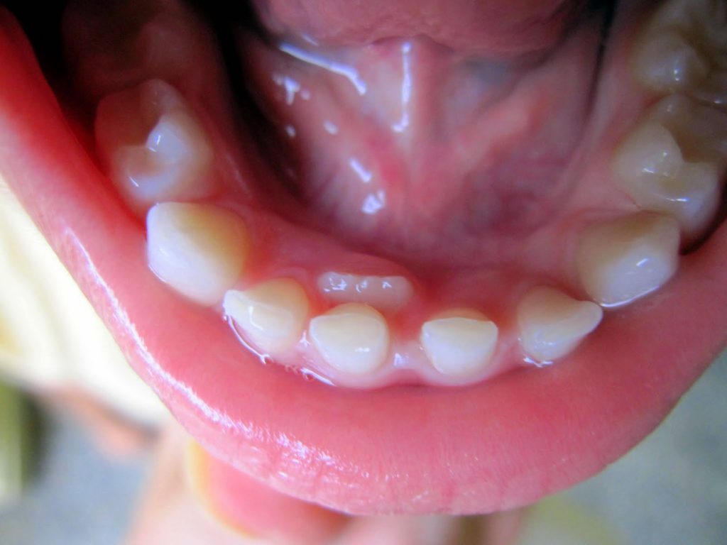 Fisher and Surger Pediatric Dentistry | Does Your Child Have Two Rows ...